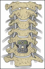 Anterior Cervical Discectomy and Fusion (ACDF)